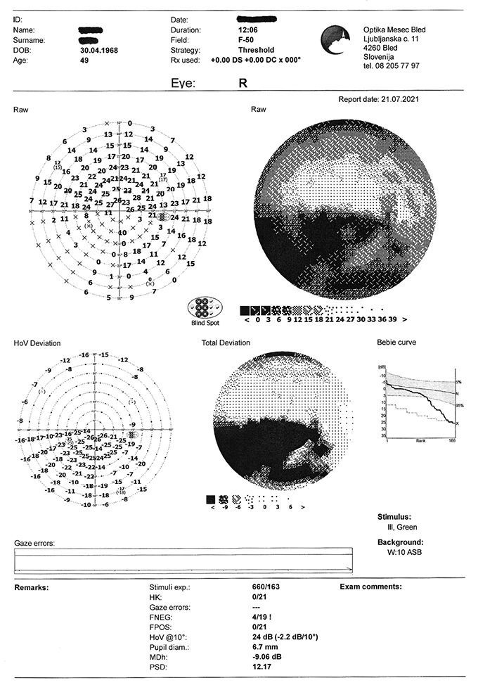 Non-Arteritic Anterior Ischemic Optic Neuropathy | OCL